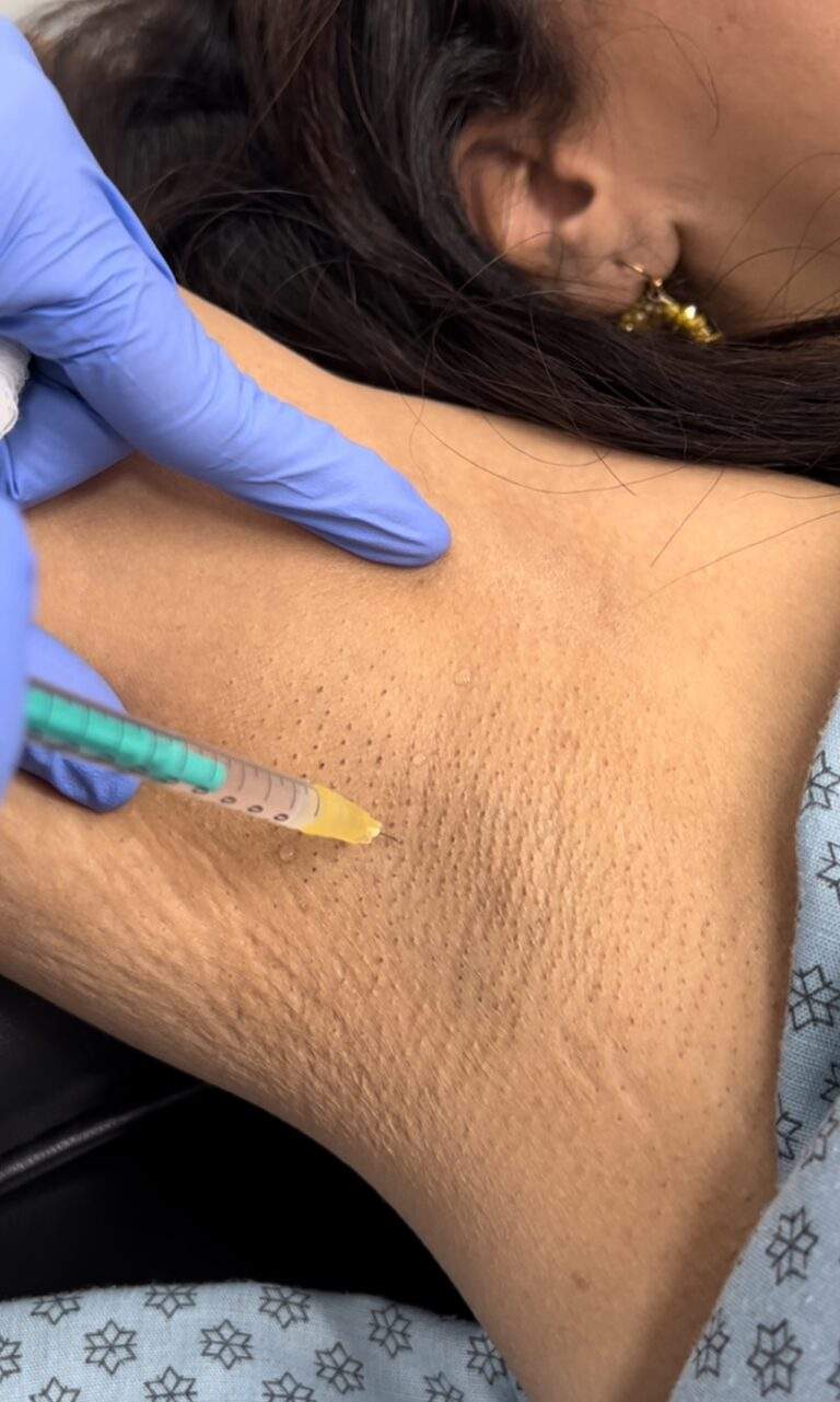 Excessive Sweating Treatment- Minneapolis, MN | Tareen Dermatology ...